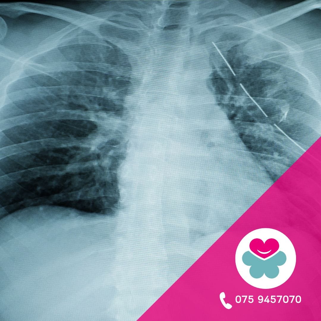 Sintomi Frattura Costole: Cause, Trattamenti e Riabilitazione - Quasar ...